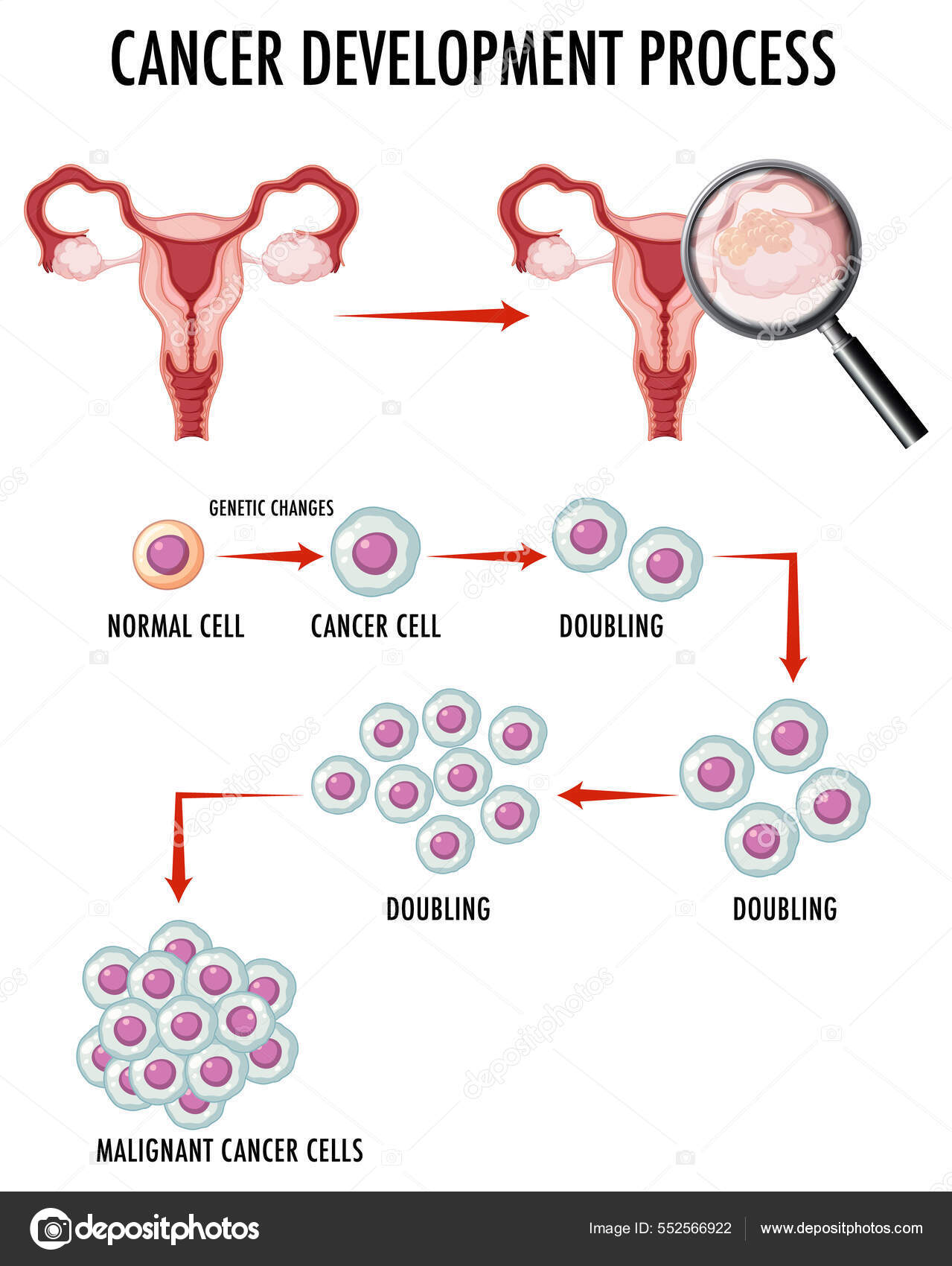 Diagram Showing Cancer Development Process Illustration Stock Vector by ...