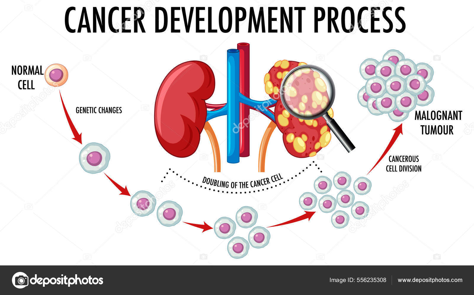 Diagram Showing Cancer Development Process Illustration Stock Vector ...