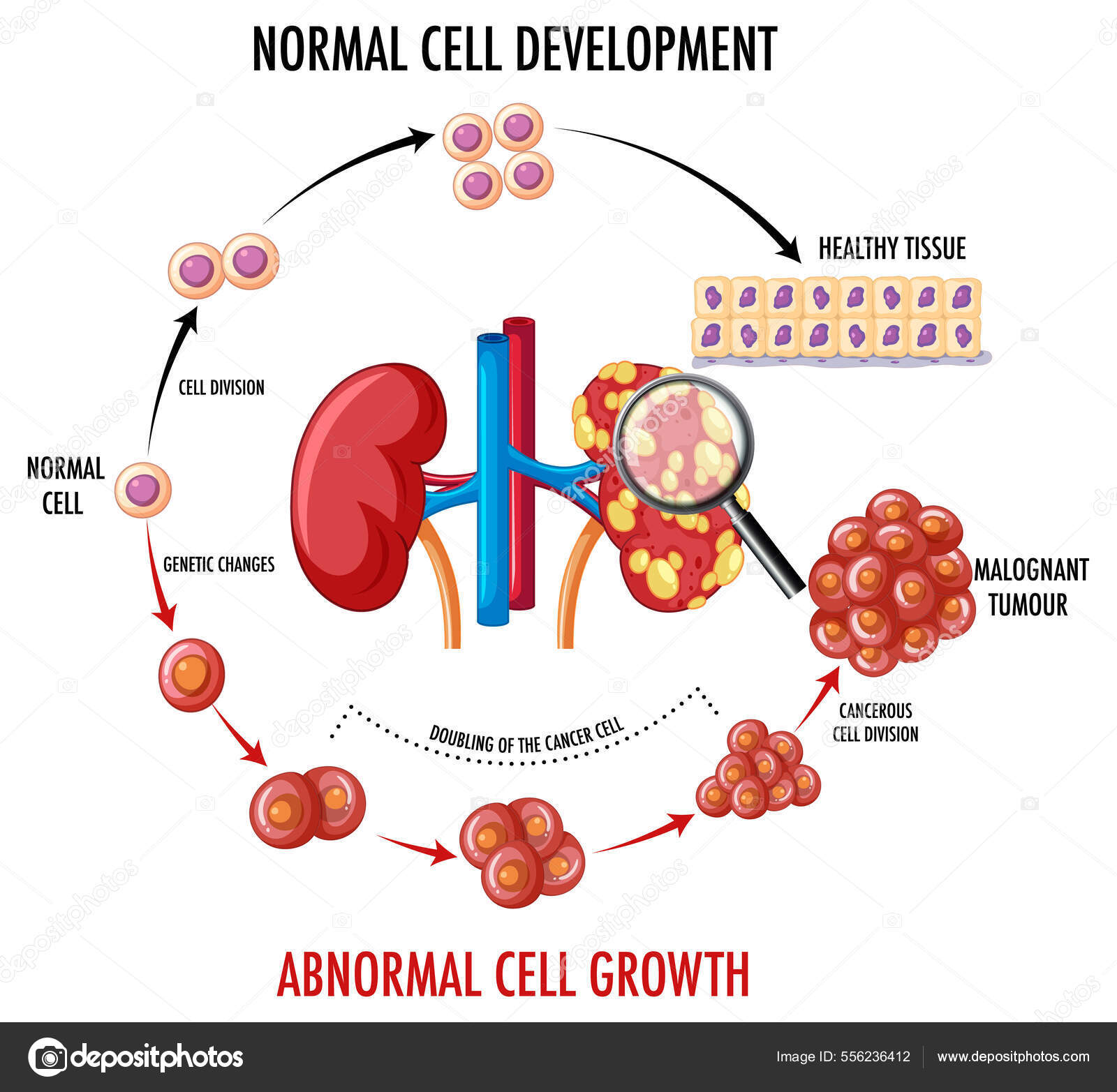 Diagrama Mostrando Ilustração Normal Células Cancerígenas Vetor de ...