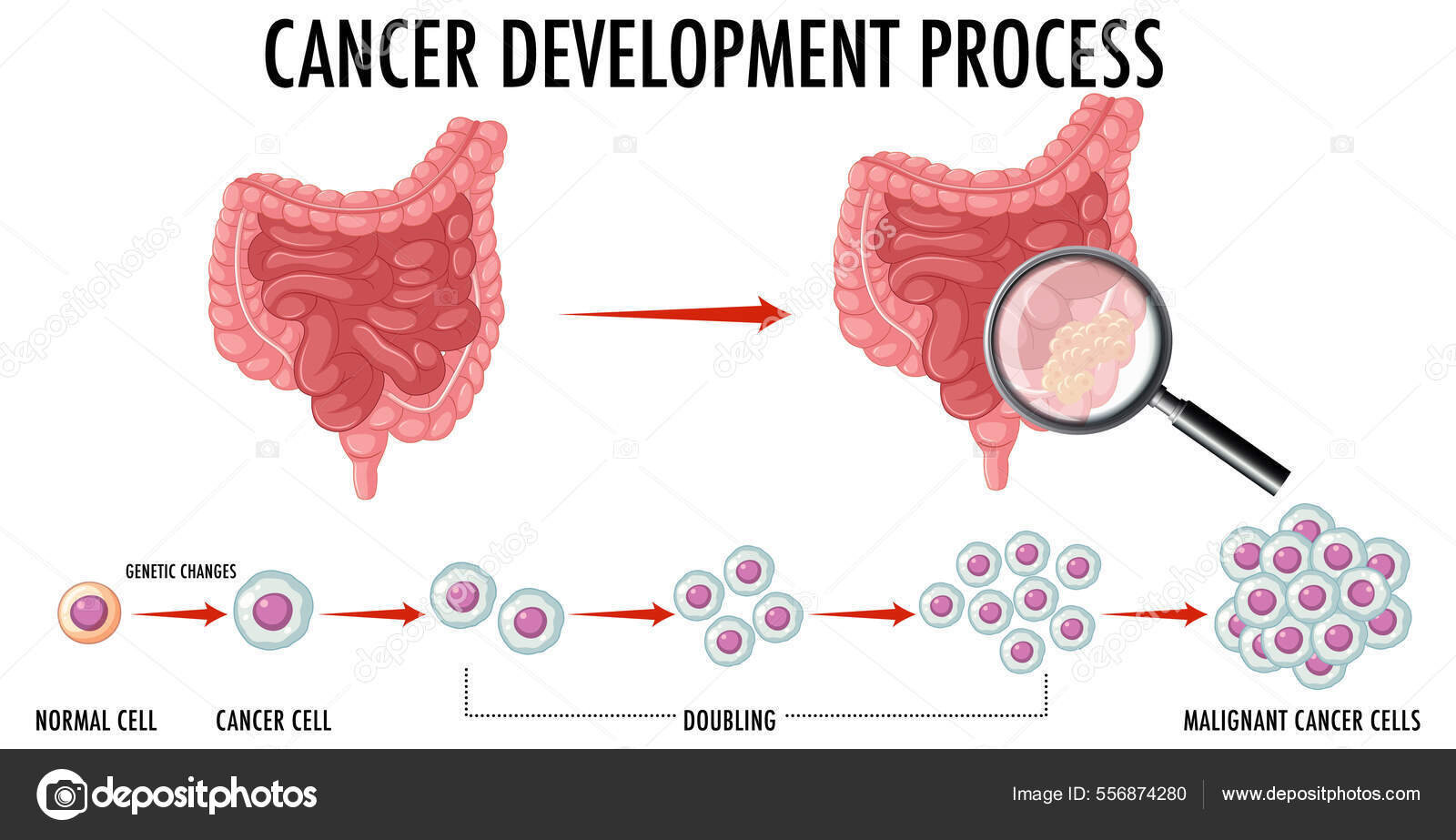 Diagrama Que Muestra Ilustración Del Proceso Desarrollo Del Cáncer ...