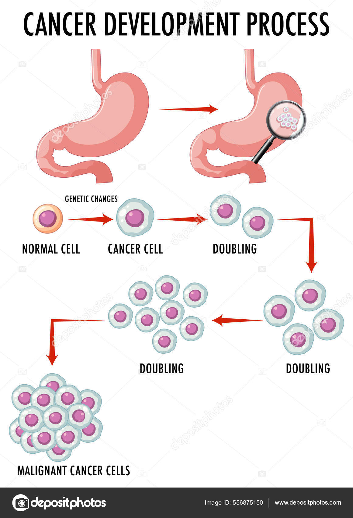 Diagram Showing Cancer Development Process Illustration Stock Vector By ©interactimages 556875150