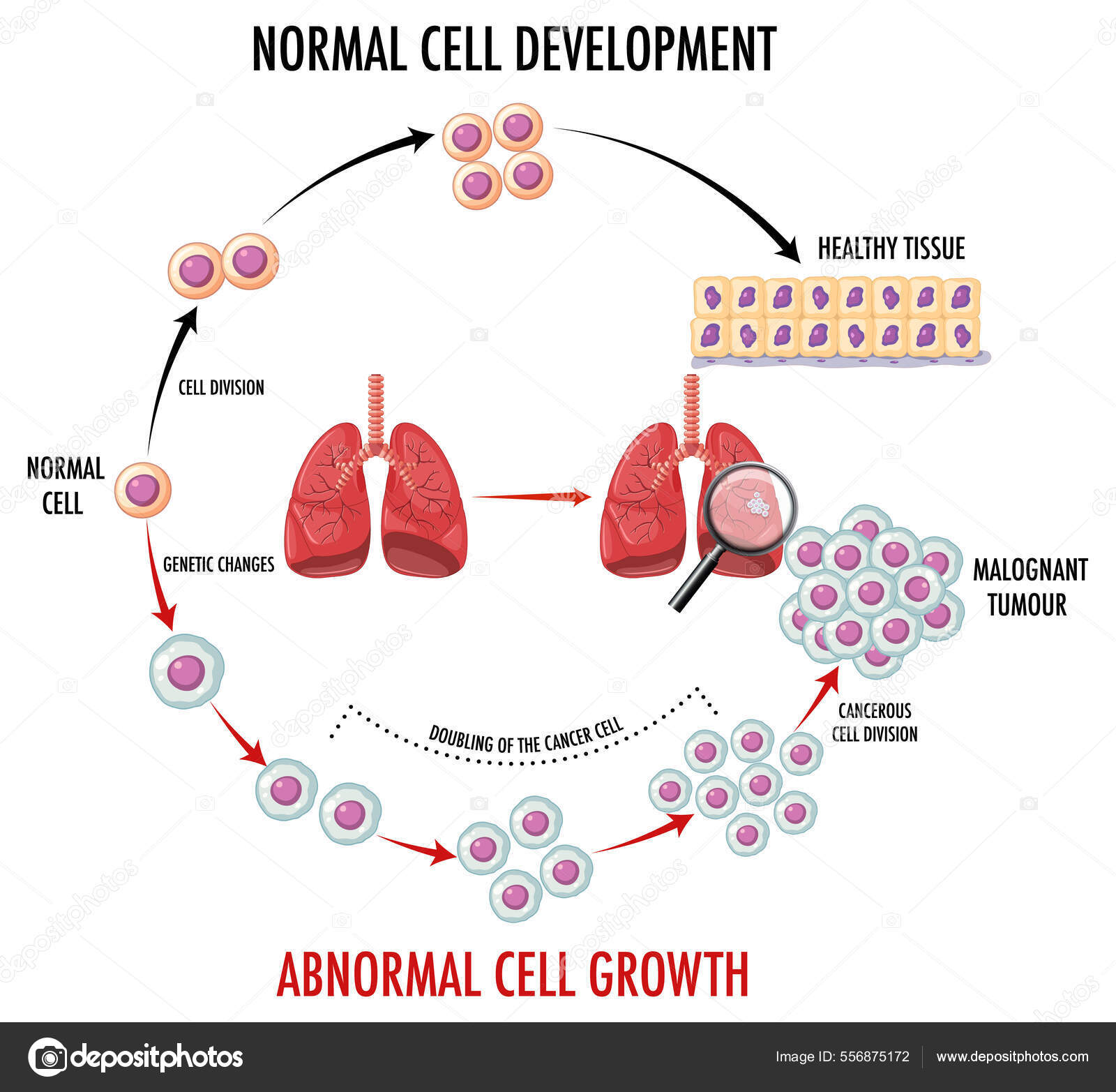 Diagram Showing Cancer Development Process Illustration Stock Vector by ...
