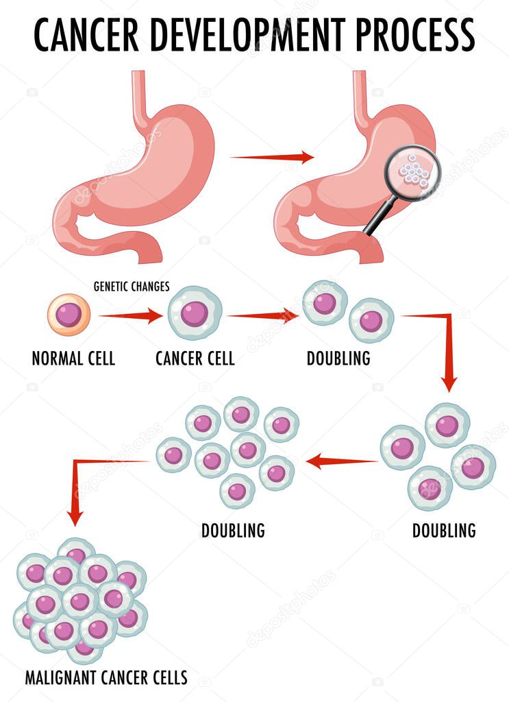 Diagrama Que Muestra Ilustración Del Proceso Desarrollo Del Cáncer ...