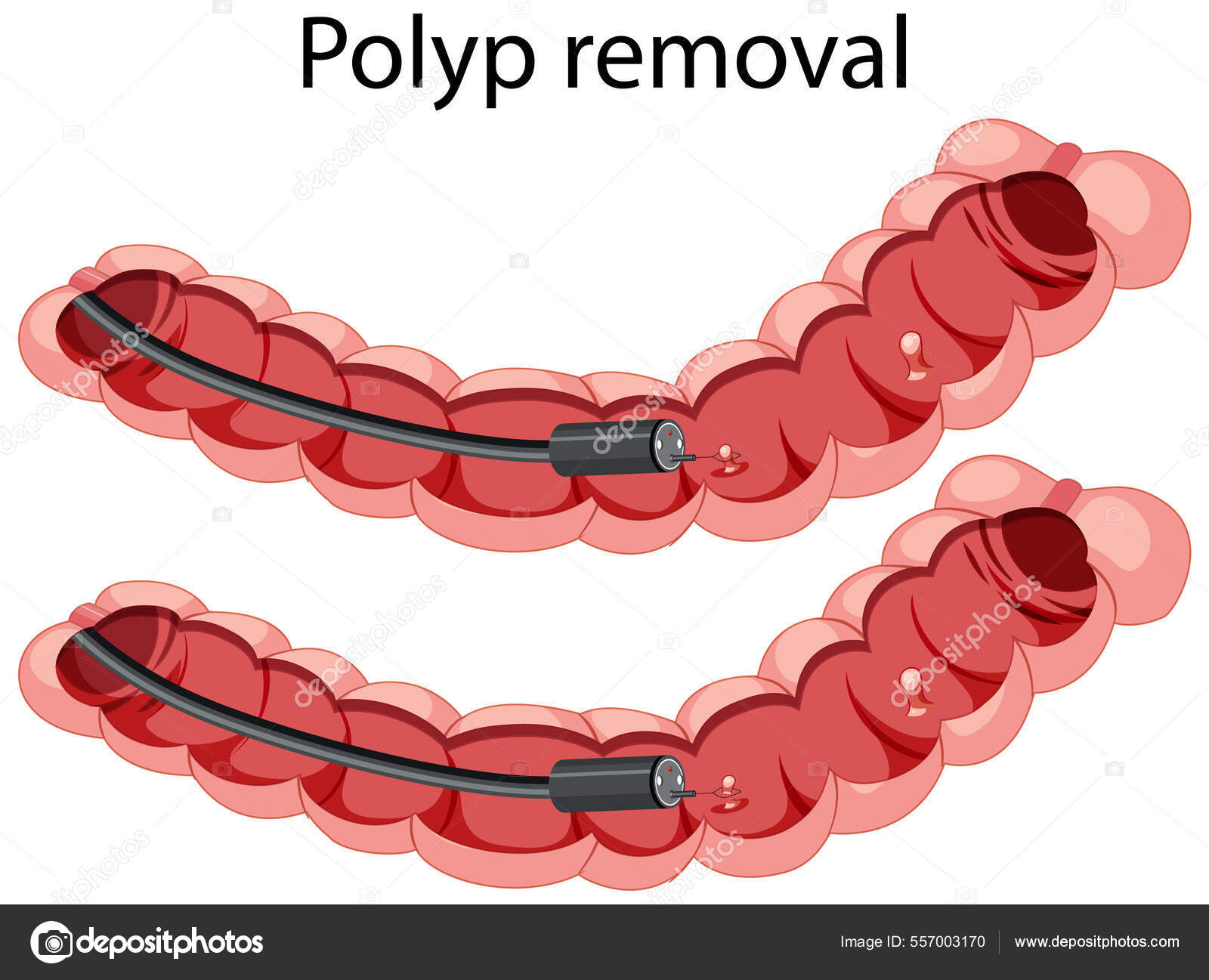 Diagrama Que Muestra Ilustración Eliminación Pólipos Vector de stock ...