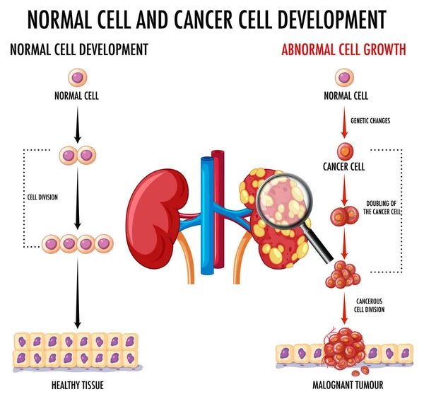 Diagram Showing Cancer Development Process Illustration Stock Vector ...