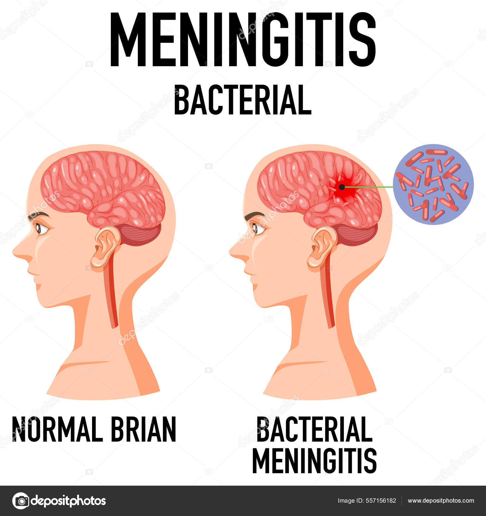 Diagram Showing Meningitis Bacterial Brain Illustration Stock Vector ...