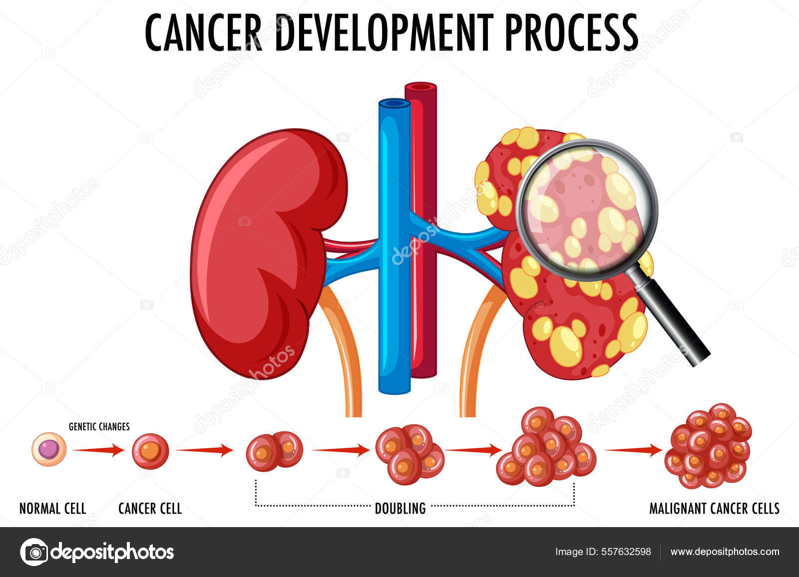 Diagram Showing Cancer Development Process Illustration Stock Vector ...