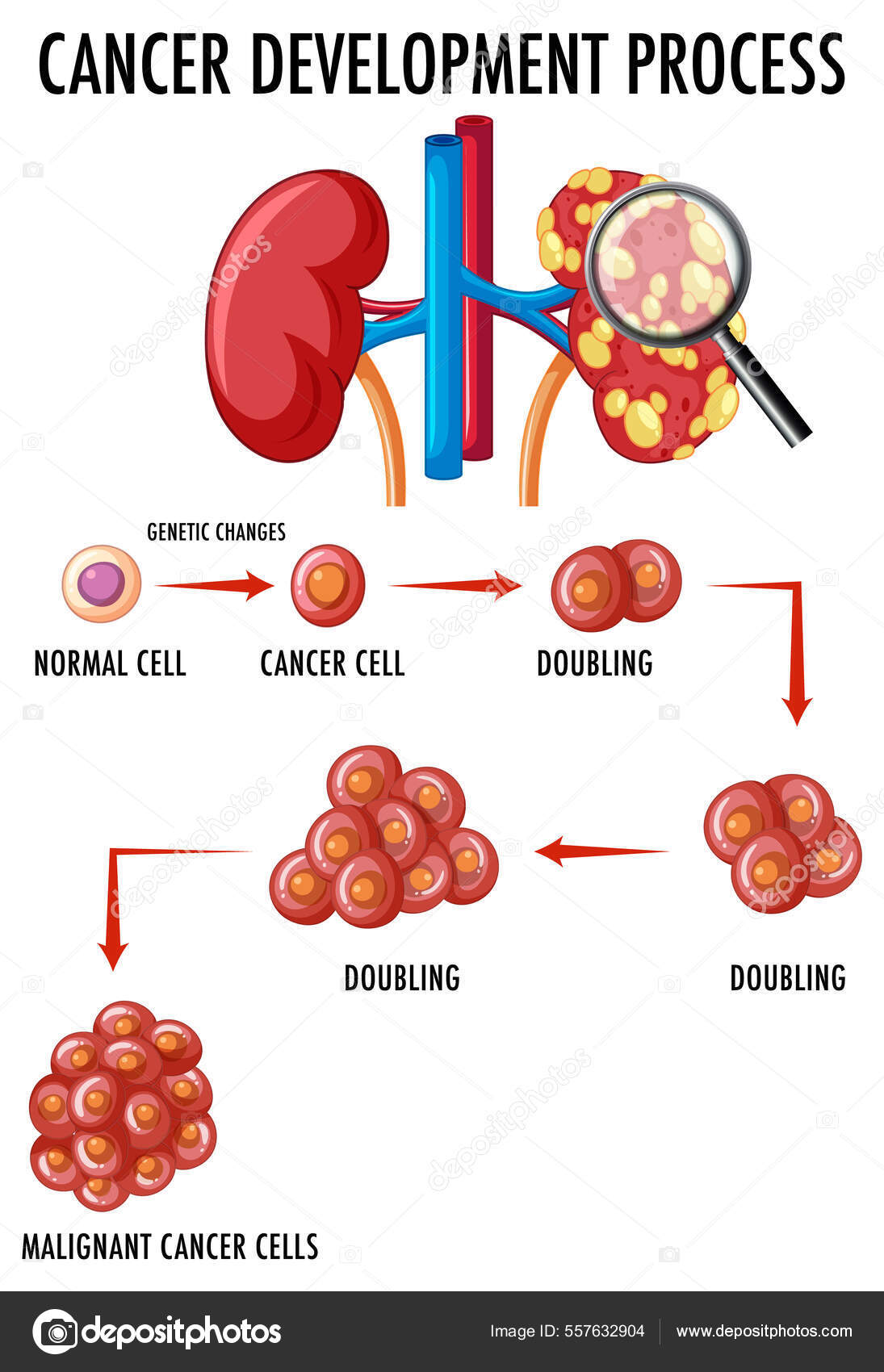 Diagram Showing Cancer Development Process Illustration Stock Vector ...