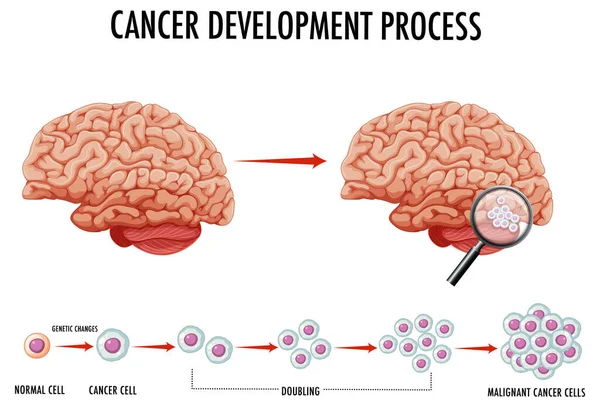 Diagram Showing Cancer Development Process Illustration Stock Vector by ...
