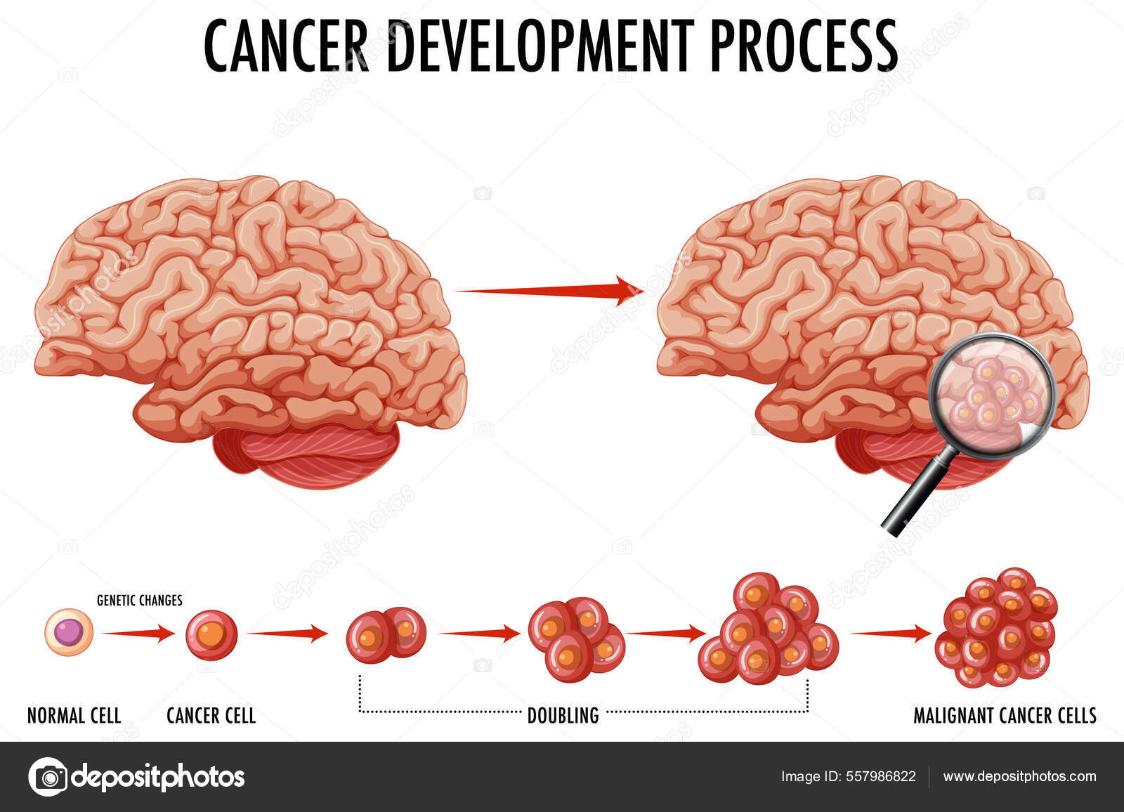 Diagrama Que Muestra Cerebro Humano Ilustración Del Cáncer Vector de ...