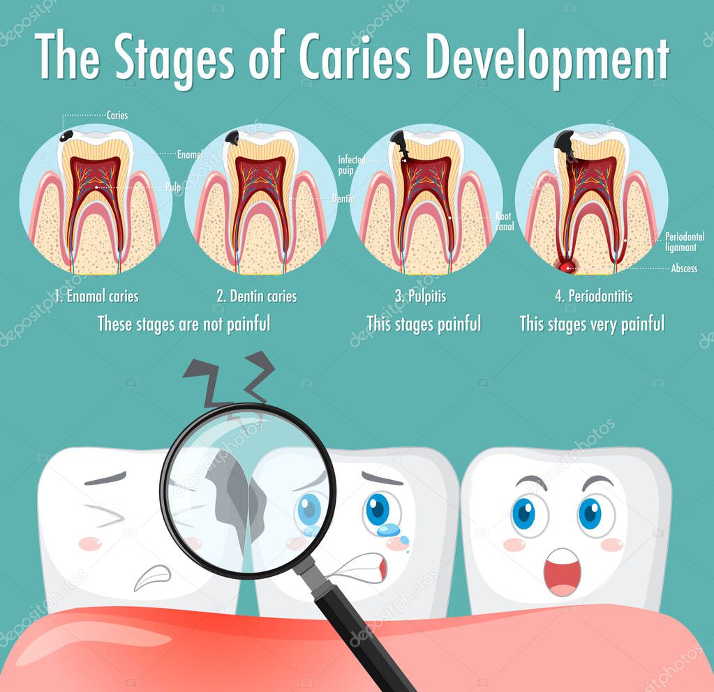 Infografía del ser humano en etapas de desarrollo de la caries ...