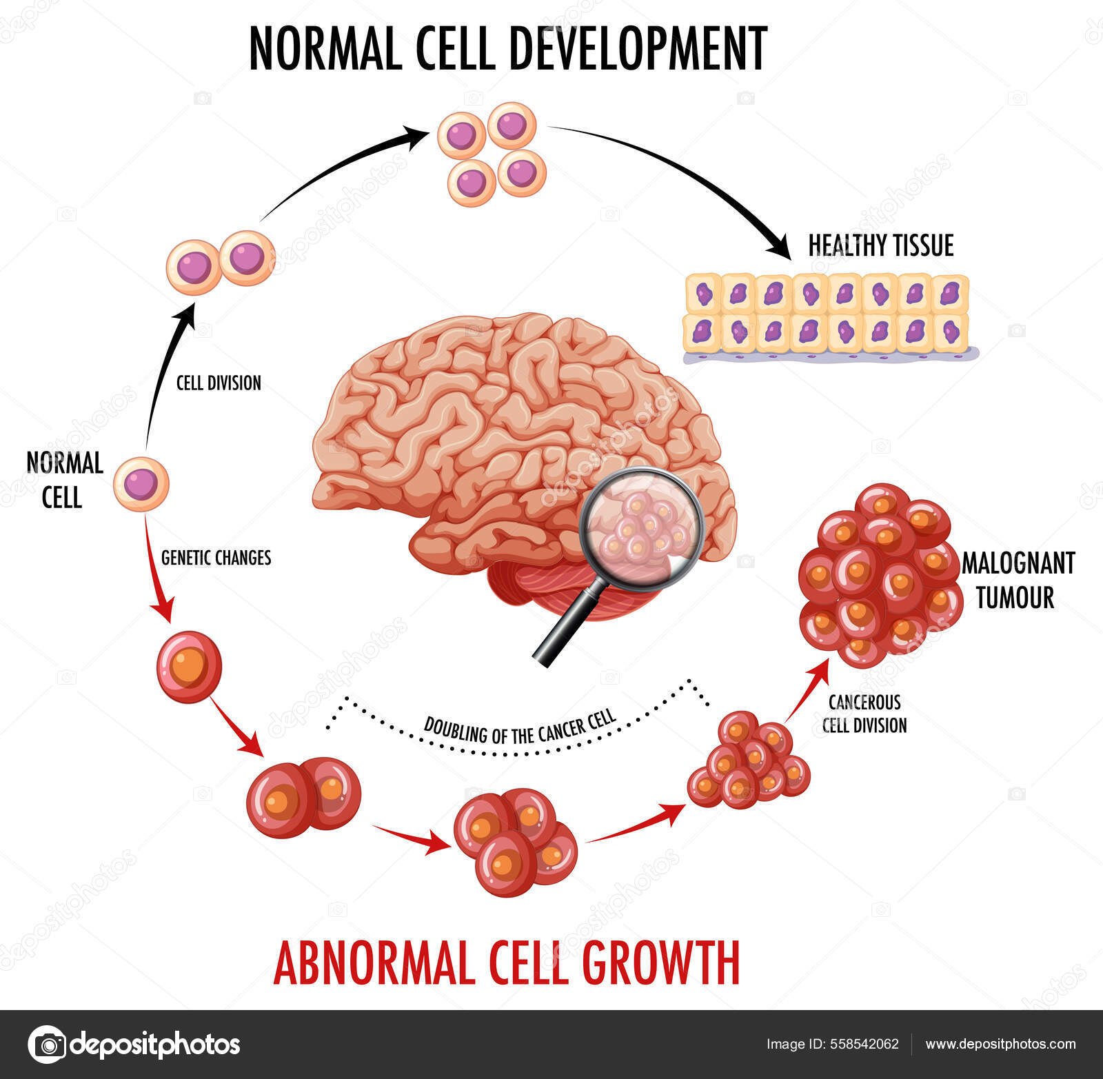 Diagram Showing Human Brain Cancer Illustration Stock Vector by ...