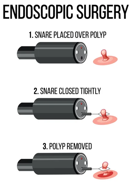 Diagram Showing Removal Polyps Illustration Stock Vector by ...