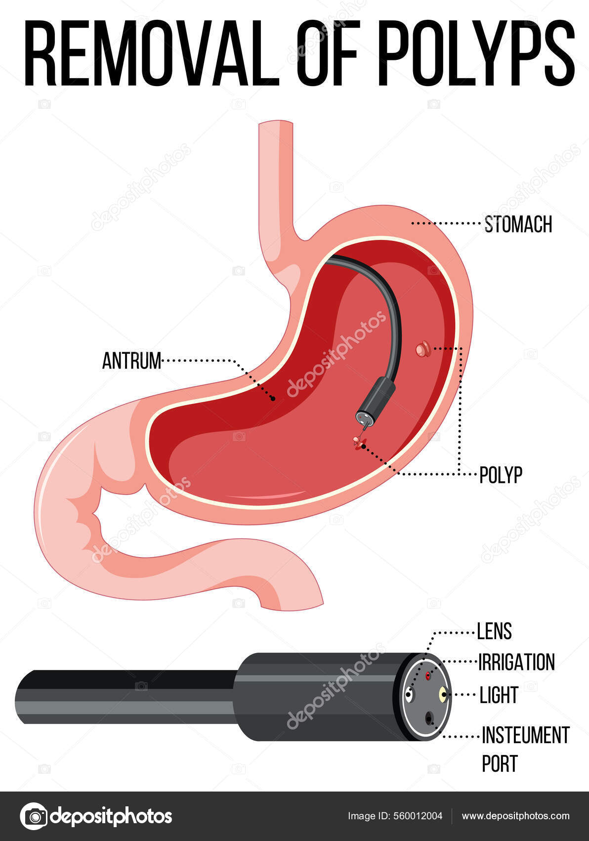 Diagrama Que Muestra Eliminación Pólipos Ilustración Vector de stock por ©interactimages 560012004