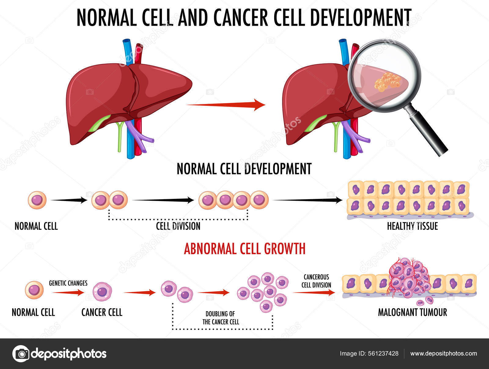 Diagram Showing Normal Cancer Cell Illustration Stock Vector Image by ...