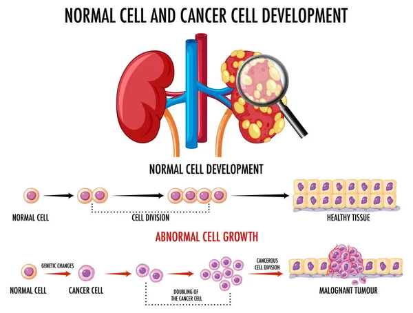 Diagram Showing Cancer Development Process Illustration Stock Vector by ...