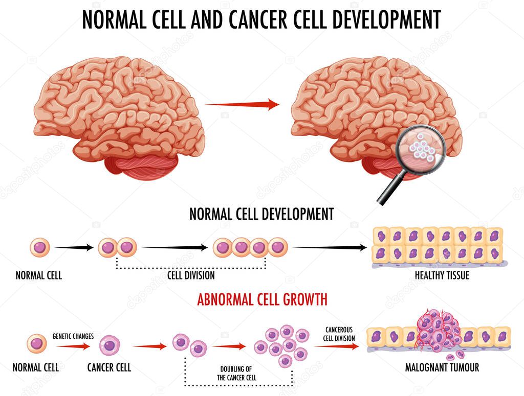 Diagrama que muestra las c lulas normales y cancerosas en la ilustraci n humana 2024
