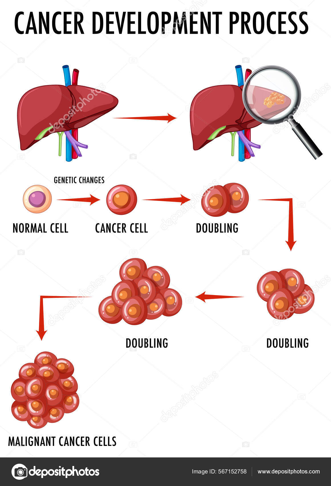 Schéma Illustrant Processus Développement Cancer Vecteur par ...