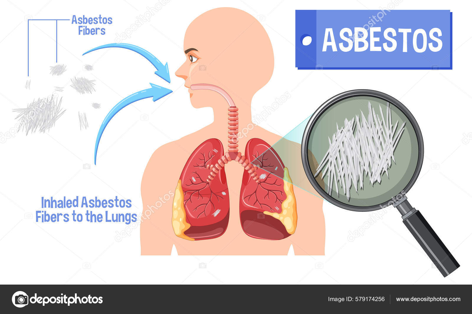 Grafik Zeigt Asbestose Der Lunge Illustration - Vektorgrafik ...