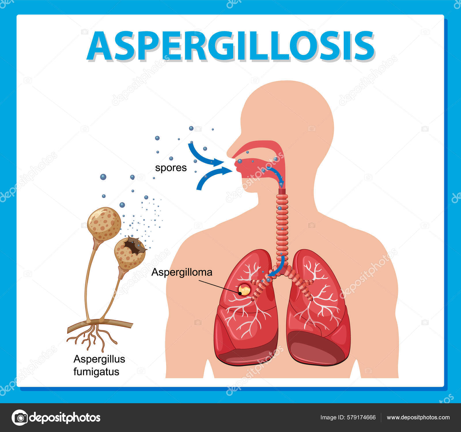Diagrama Que Muestra Ilustración Infección Por Aspergillus Vector de ...