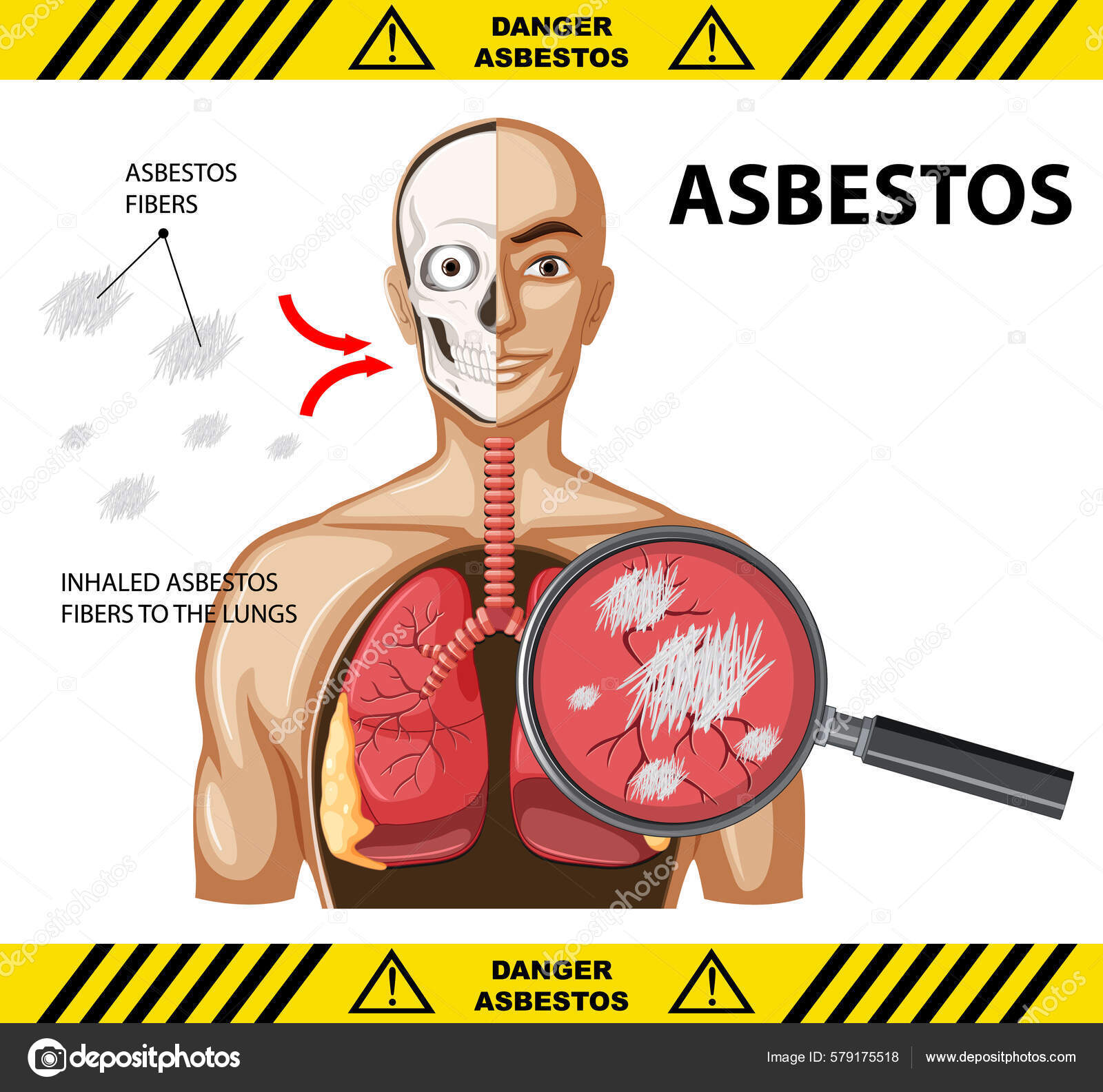 Diagram Showing Asbestosis Lungs Illustration Stock Vector by ...