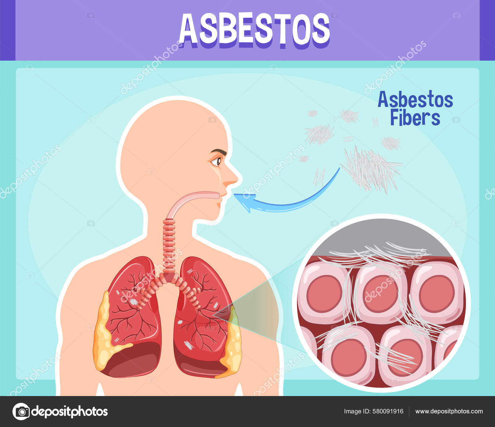 Diagram Showing Asbestosis Lungs Illustration Stock Vector Image by ...