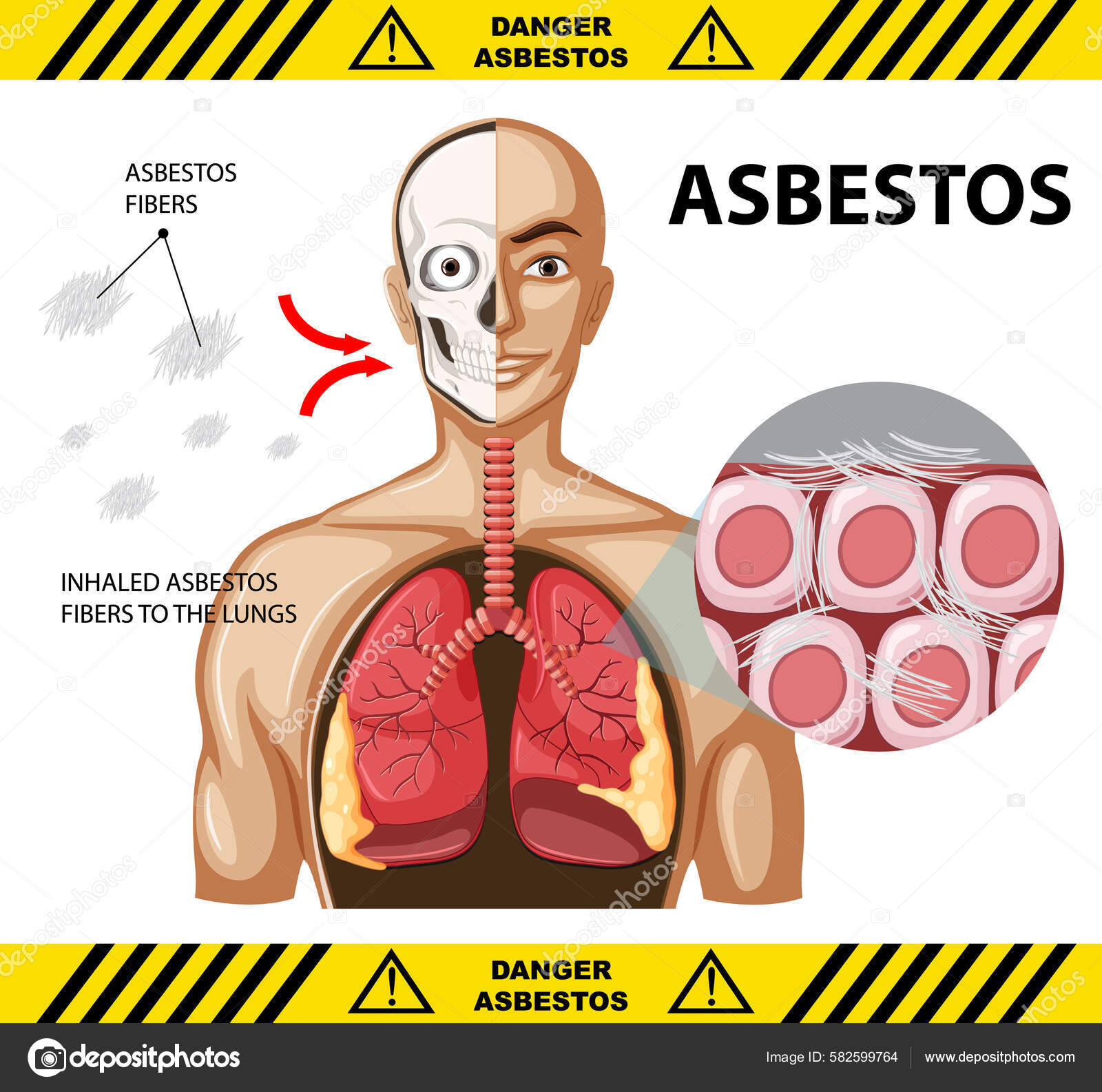 Diagram Som Visar Asbestos Lungorna Illustration — stockvektor av ...