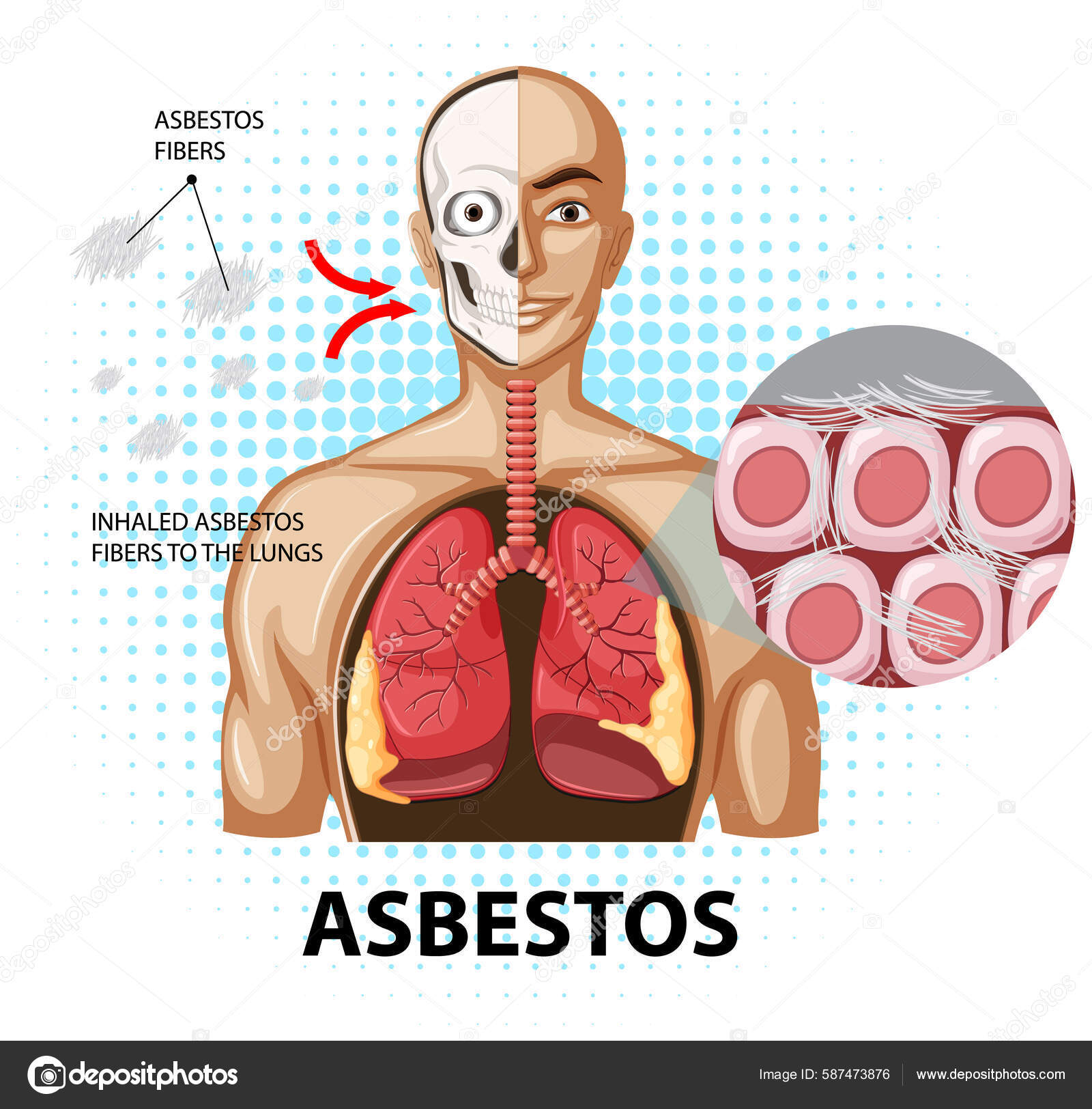 Diagram Showing Asbestosis Lungs Illustration Stockvektor af ...