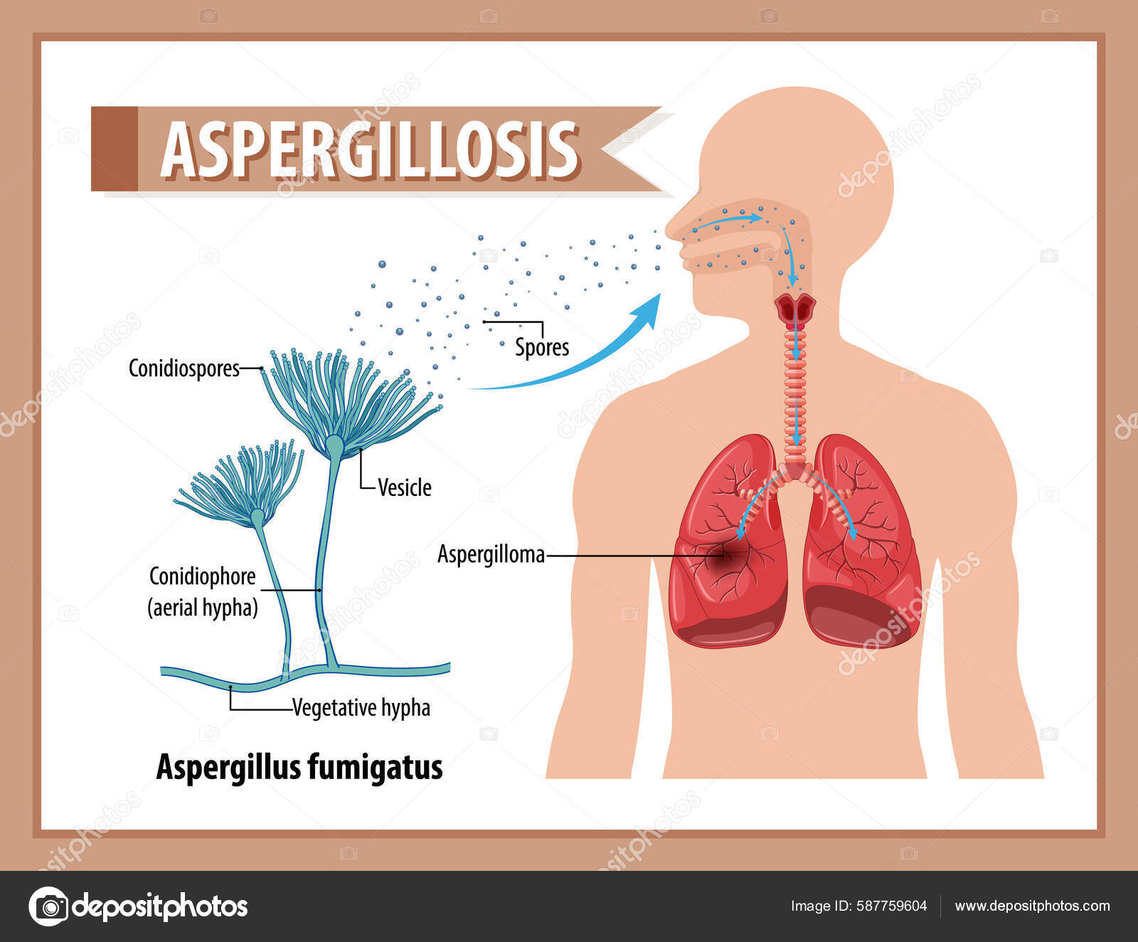 Diagrama Que Muestra Ilustración Infección Por Aspergillus Vector de stock por ©interactimages ...