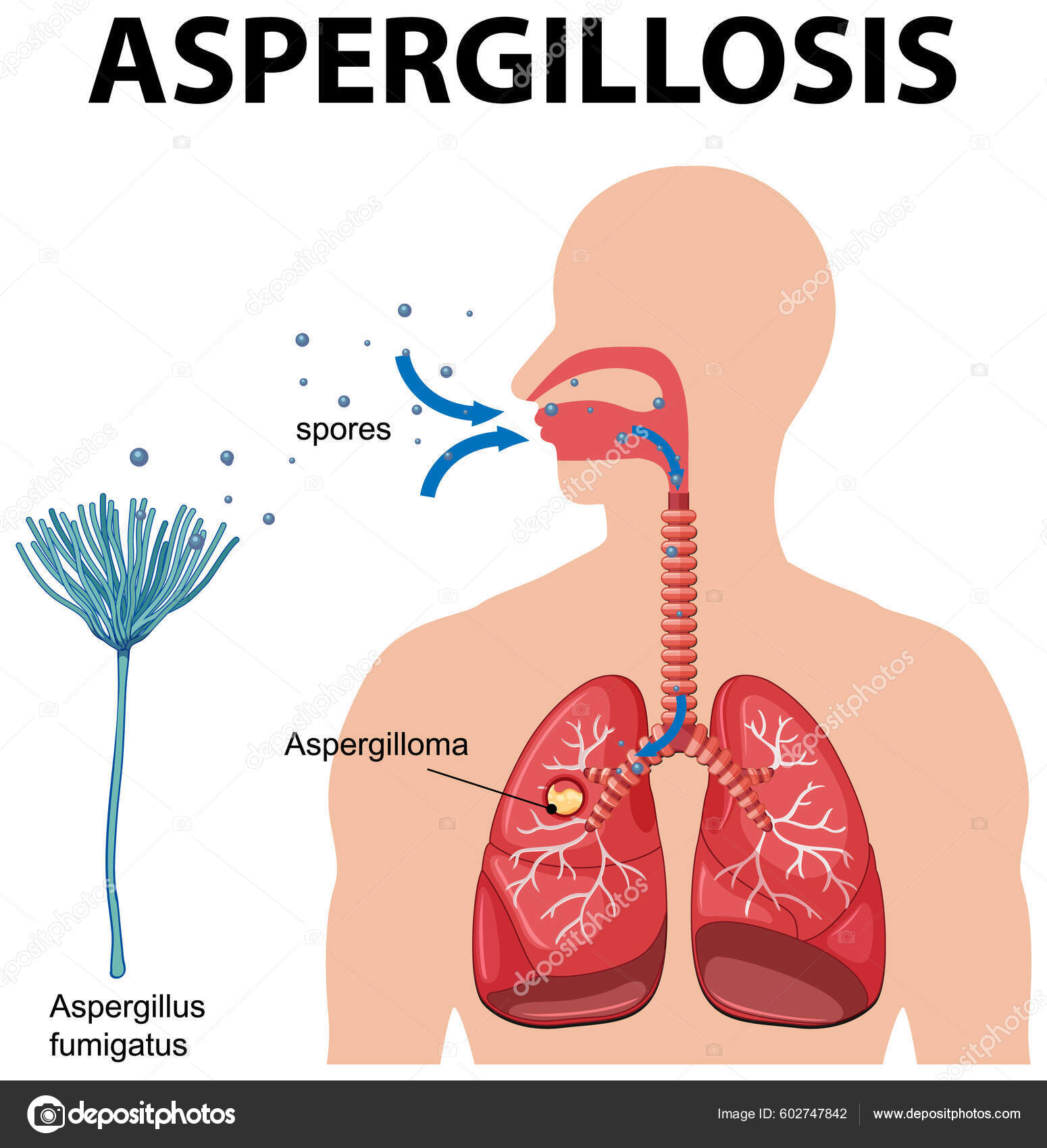 Diagram Showing Aspergillus Infection Illustration Stock Illustration ...