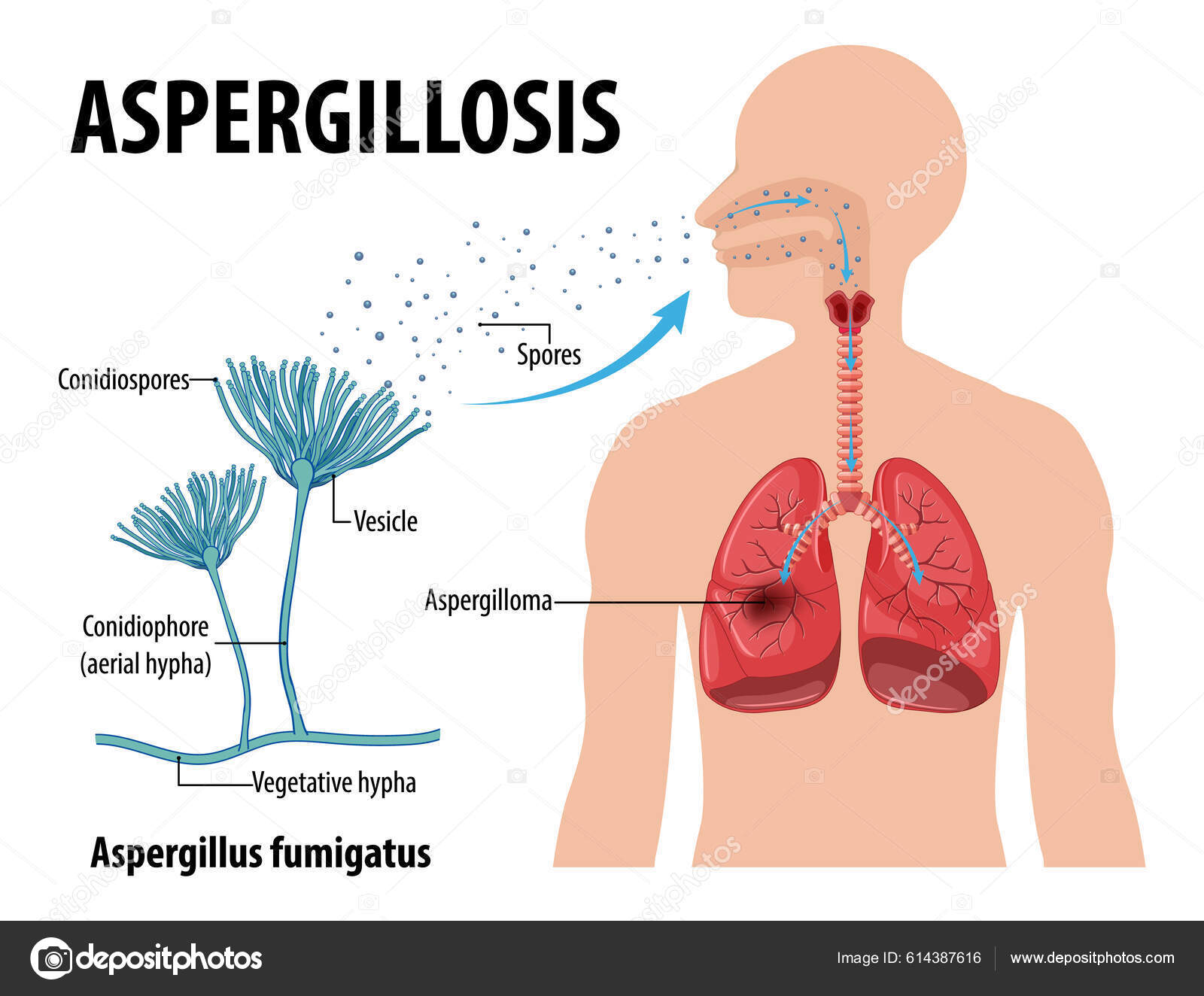 Diagrama Que Muestra Ilustración Infección Por Aspergillus Vector De Stock 614387616 De