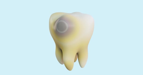 14 Stages of tooth decay Videos, Royalty-free Stock Stages of tooth ...