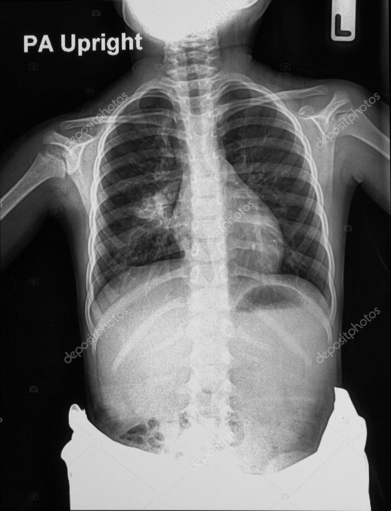 Crianças radiografia de tórax — Fotografia de stock © plepraisaeng ...