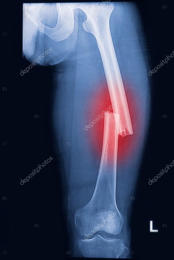 Radiografía De Pierna Rota Humana
