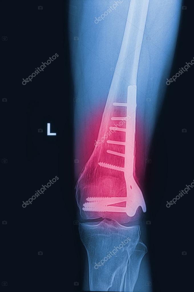 Bilder Von Gebrochenem Oberschenkelknochen Ein Mann Mit Ein Gebrochen