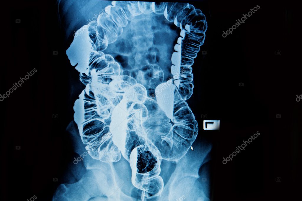 Barium enema of a man demonstrated the normal rectum and cecum — Stock ...