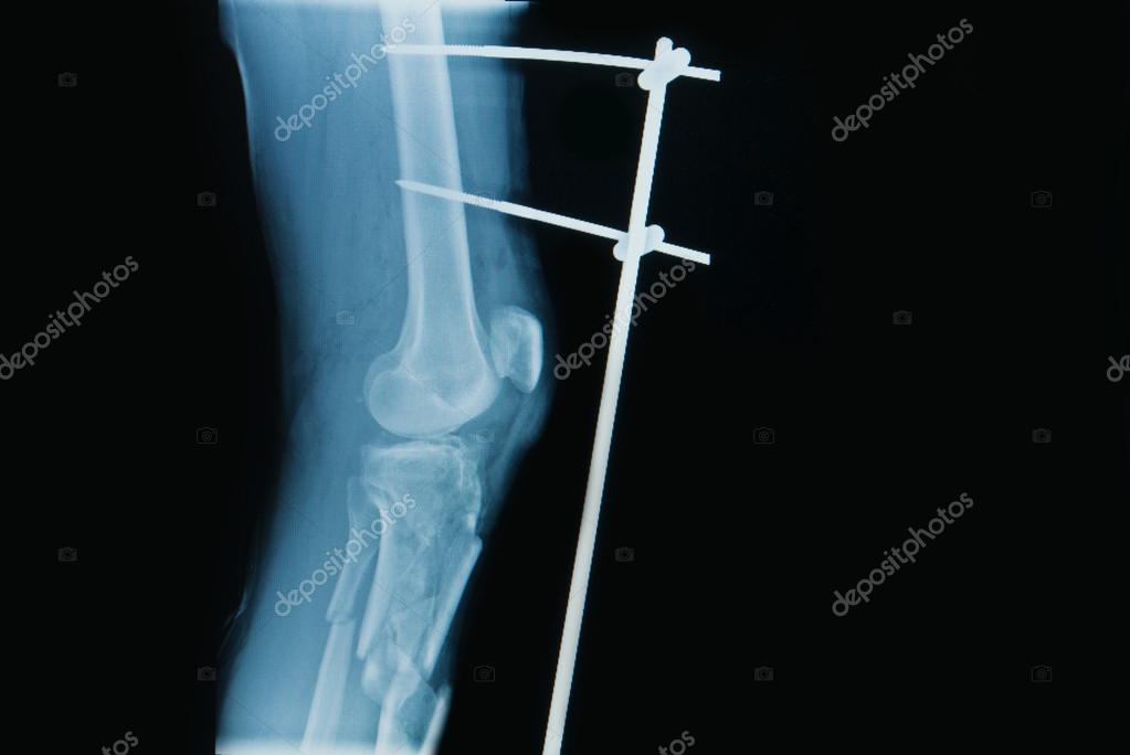 imagen de rayos X de la pierna fracturada (tibia) con fijación externa ...