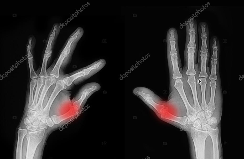 Rayos X Del Dedo Medio Roto