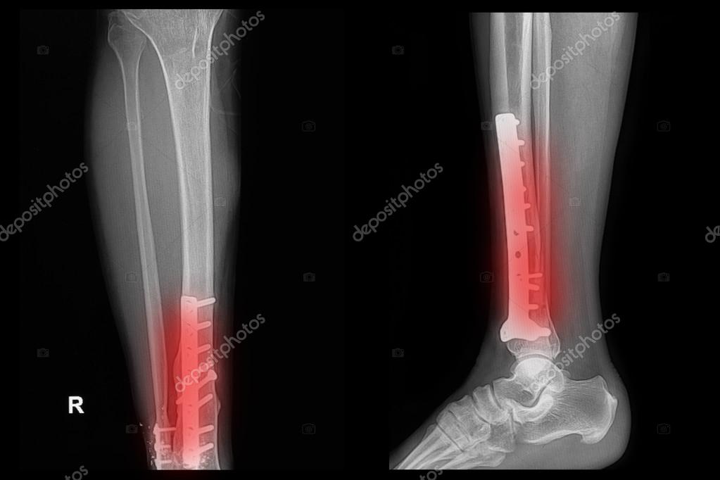 Imagen de rayos X de la pierna fracturada (tibia) con placa de implante ...