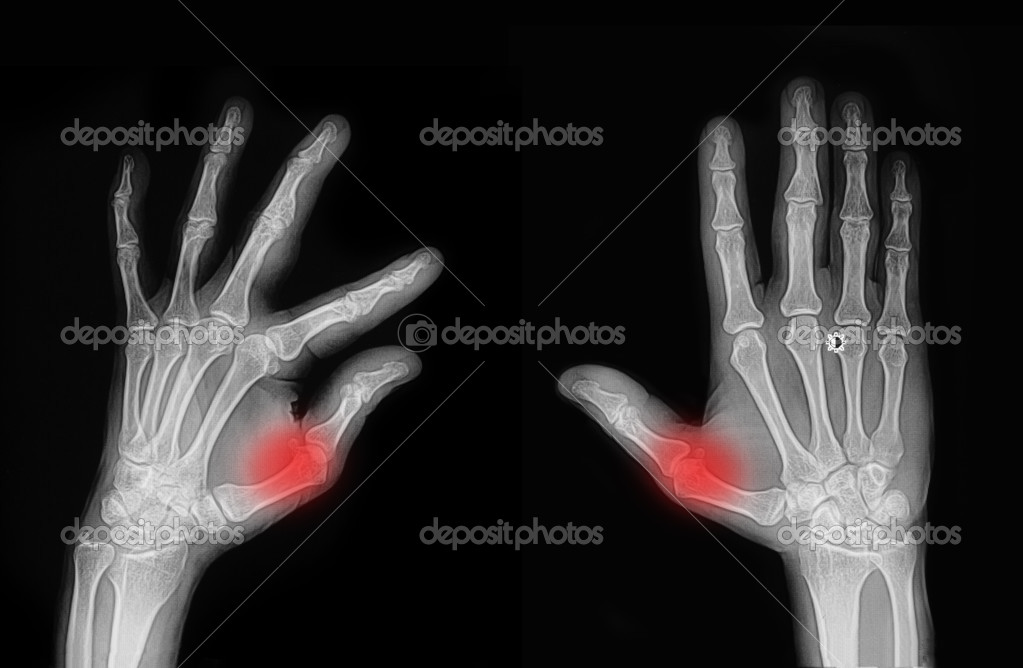 Mano y dedo de rayos X: fotografía de stock © plepraisaeng #49822617 ...