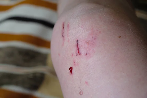 Rodilla raspada fotos de stock, imágenes de Rodilla raspada sin ...