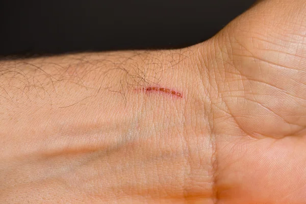 Deep Skin Cut