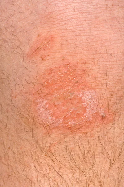 Skin affliction Stock Photos, Royalty Free Skin affliction Images ...