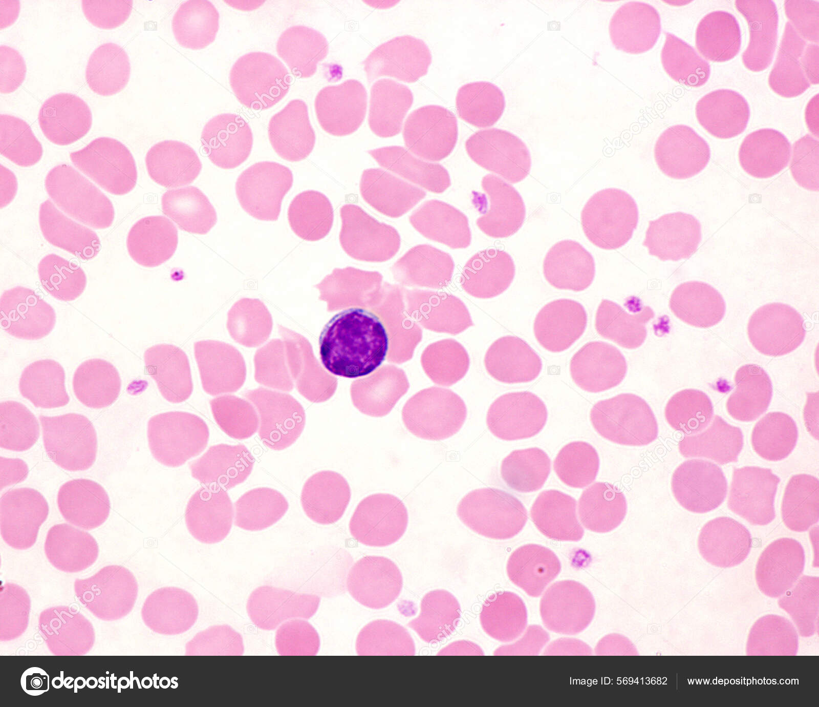Human Blood Smear Showing Lymphocyte Small Bluish Dots Red Blood Stock ...