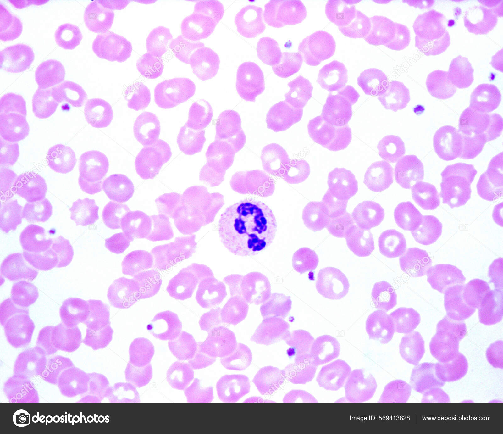 Human Blood Smear Showing Neutrophil Leukocyte Small Bluish Dots Red ...