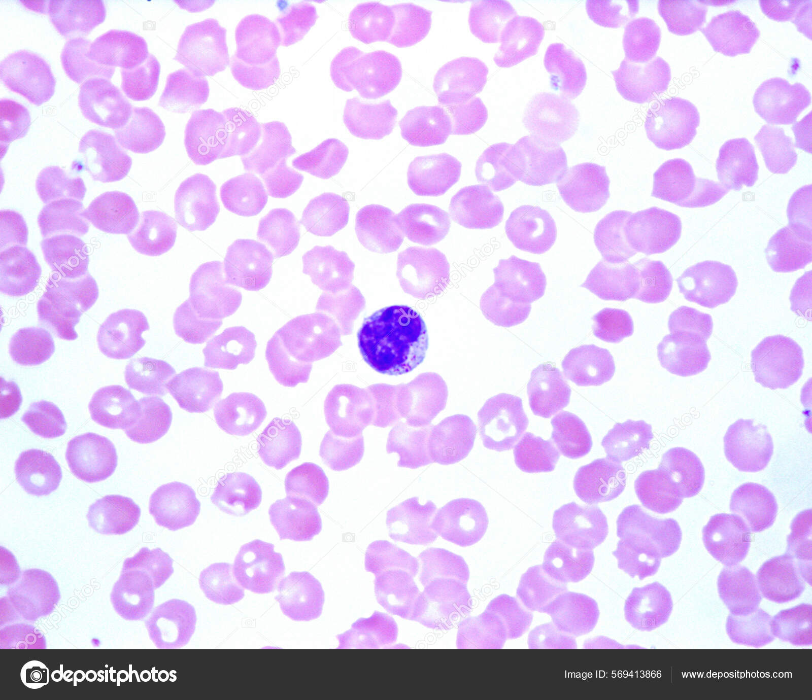 Infectious Mononucleosis Cells