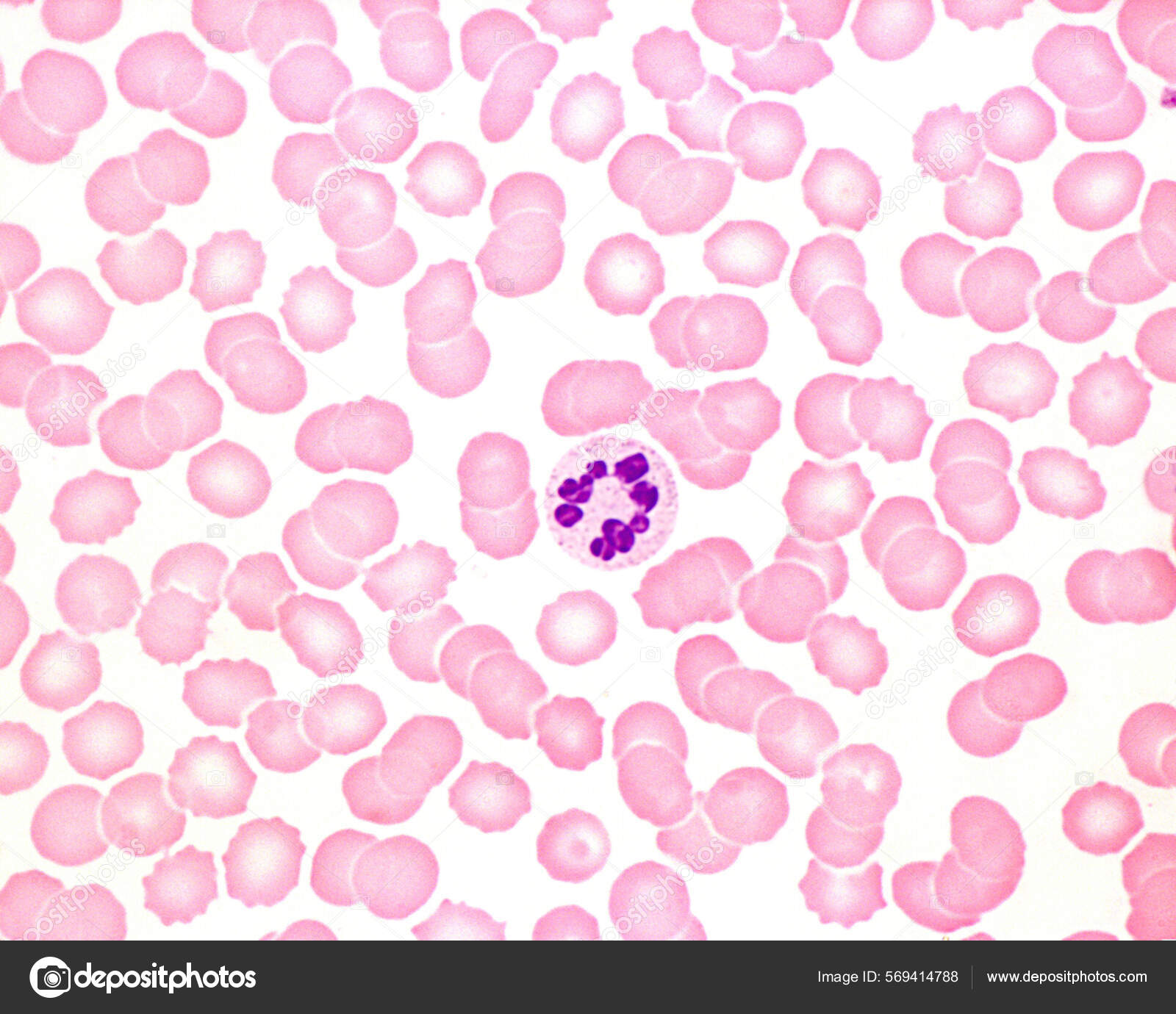 Mancha Sangue Humano Leucocitose Uma Infecção Aguda Leucócitos ...