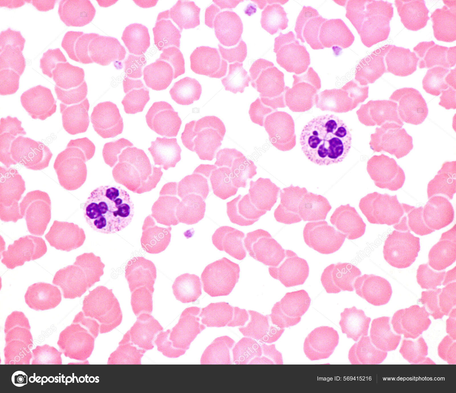 Human Blood Smear Leukocytosis Acute Infection Neutrophil Leukocyte ...
