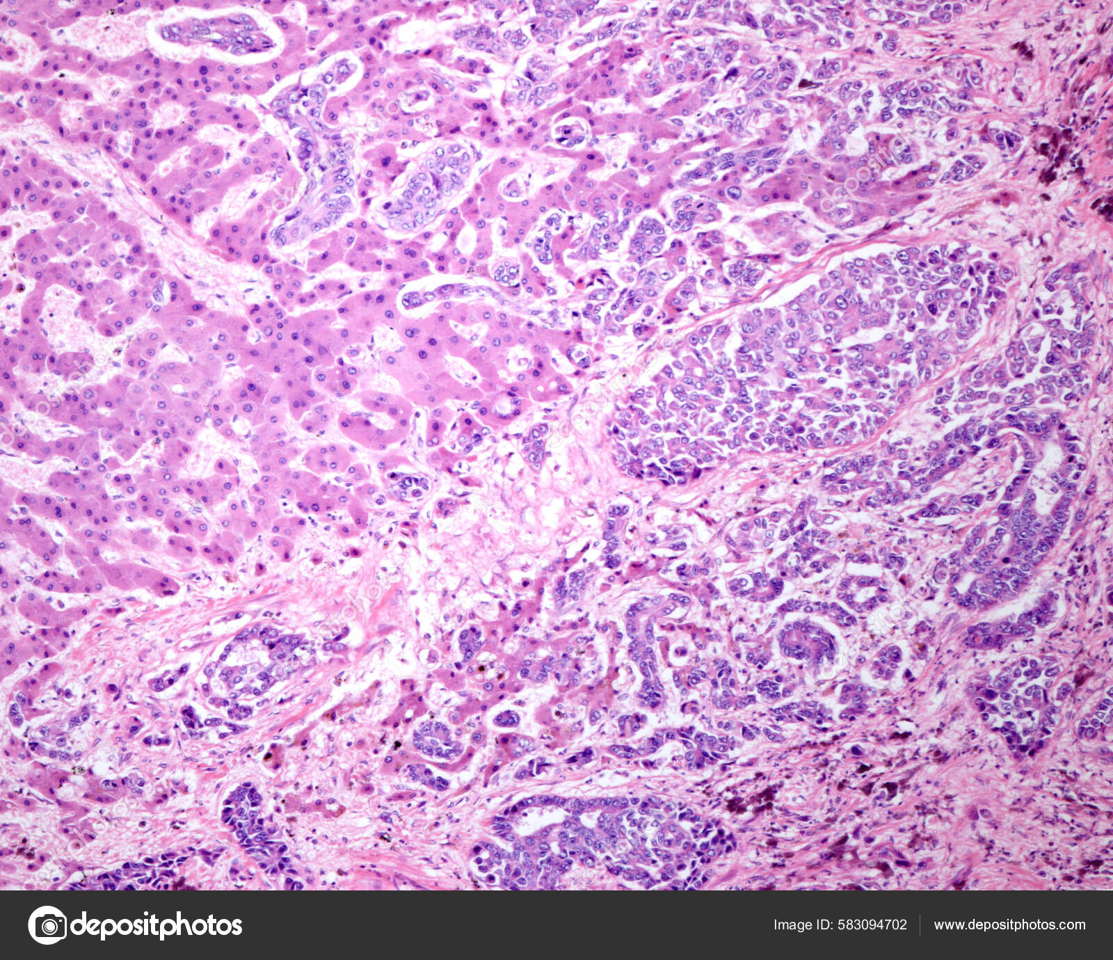 Intrahepatic Cholangiocarcinoma Ductal Type Malignant Ductular ...