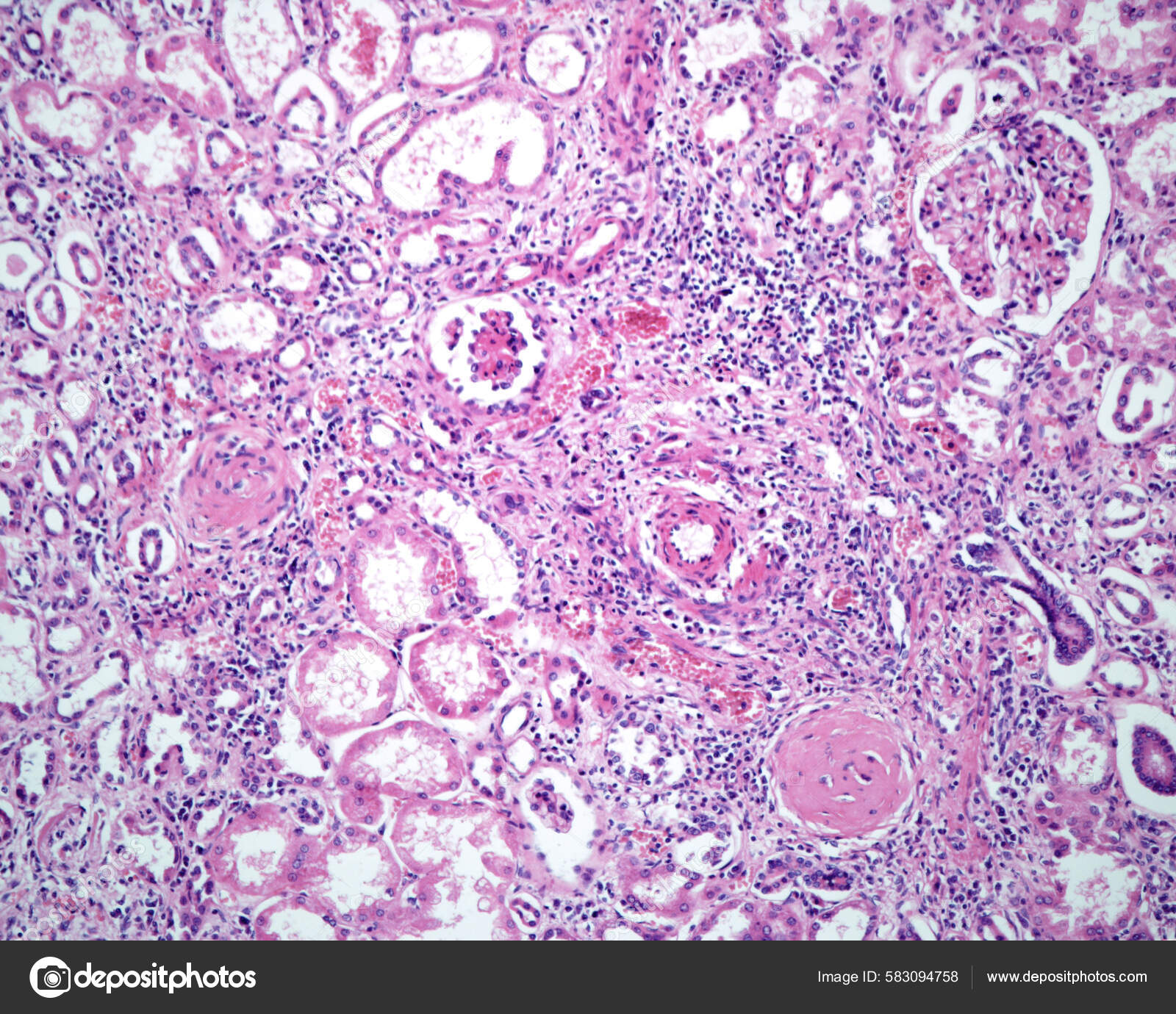 Polyarteritis Nodosa Pan Systemic Necrotizing Inflammation Blood ...